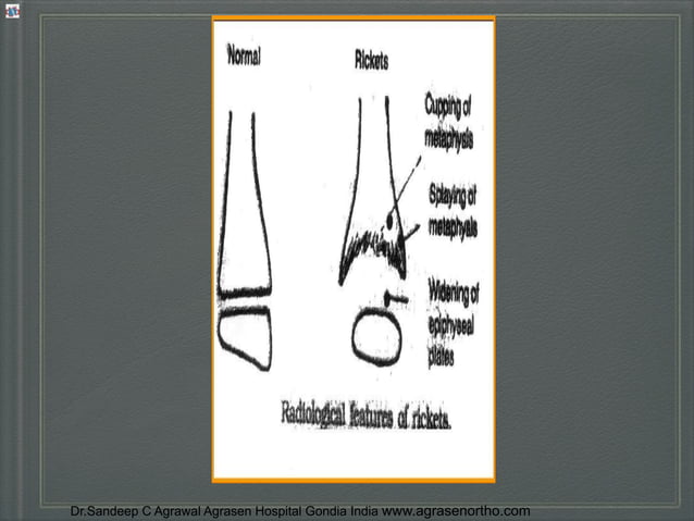 Understanding rickets types,diagnosis,prevention & treatment dr.sandeep ...