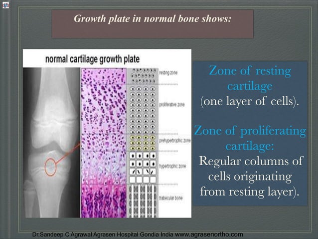 Understanding rickets types,diagnosis,prevention & treatment dr.sandeep ...