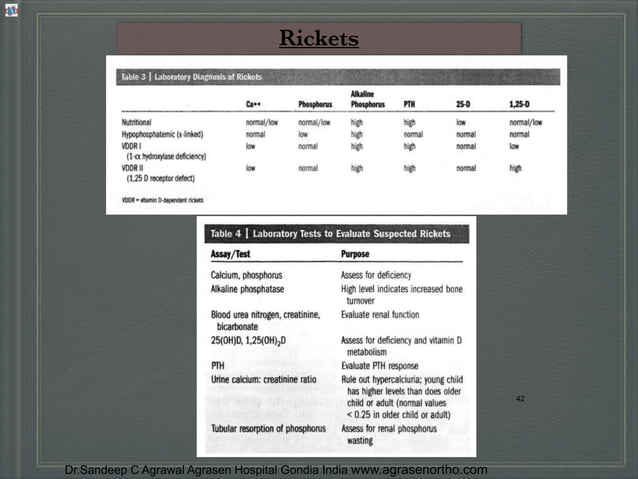 Understanding rickets types,diagnosis,prevention & treatment dr.sandeep ...
