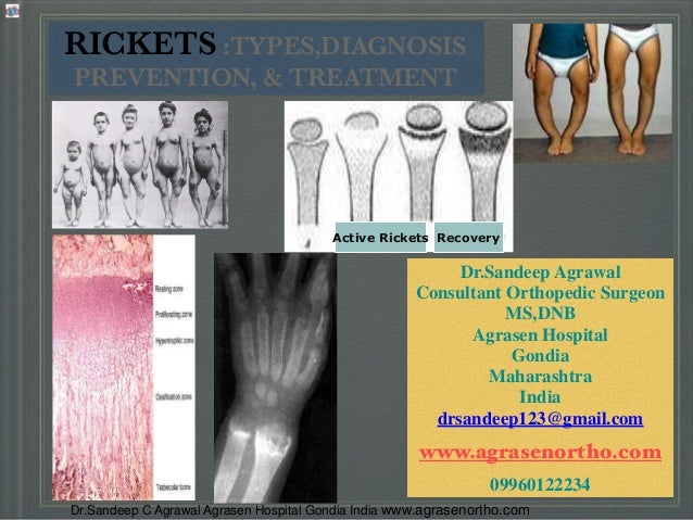 Understanding rickets types,diagnosis,prevention & treatment dr.sande…