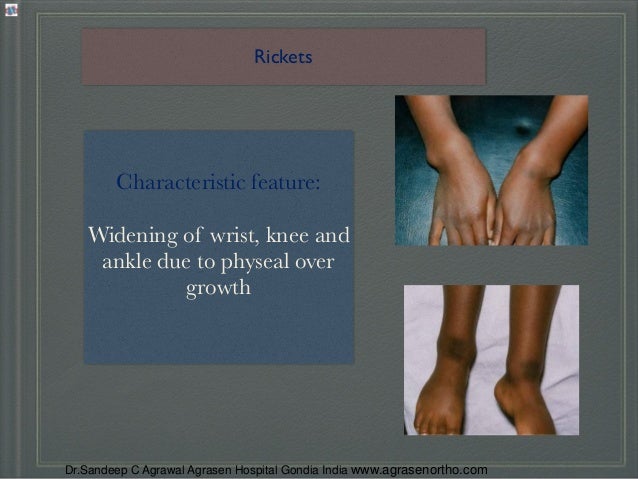 Understanding rickets types,diagnosis,prevention & treatment dr.sande…