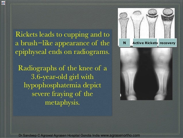 Understanding rickets types,diagnosis,prevention & treatment dr.sande…