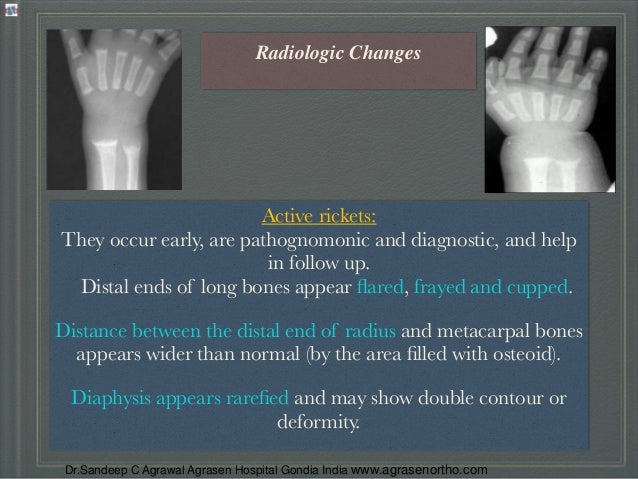 Understanding rickets types,diagnosis,prevention & treatment dr.sande…