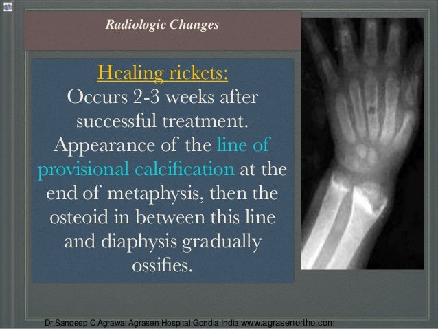 Understanding rickets types,diagnosis,prevention & treatment dr.sande…