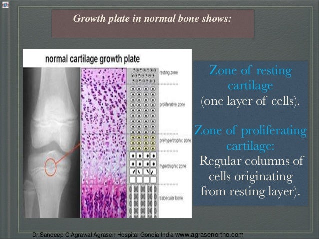 Understanding rickets types,diagnosis,prevention & treatment dr.sande…