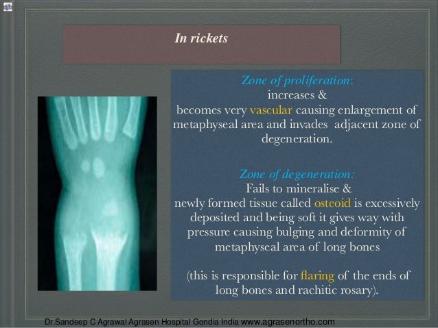 Understanding rickets types,diagnosis,prevention & treatment dr.sande…
