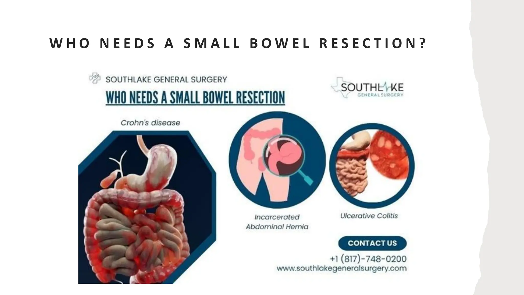 Understanding Small Bowel Resection.pdf