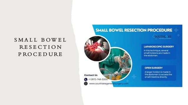 Understanding Small Bowel Resection.pdf