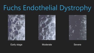 Understanding Specular Microscopy.ppt | Eye and Vision Conditions ...