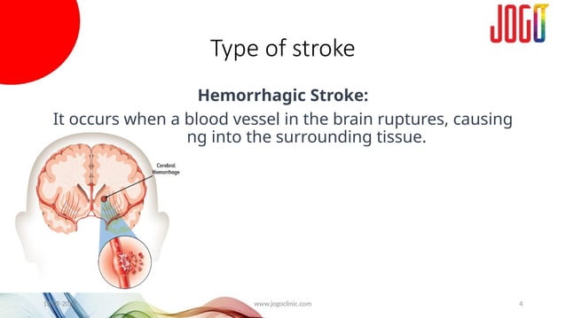 Understanding Stroke - Definition, Types, Risk Factors , Management .pptx