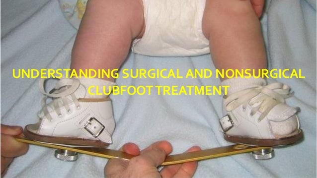 Understanding surgical and nonsurgical clubfoot treatment