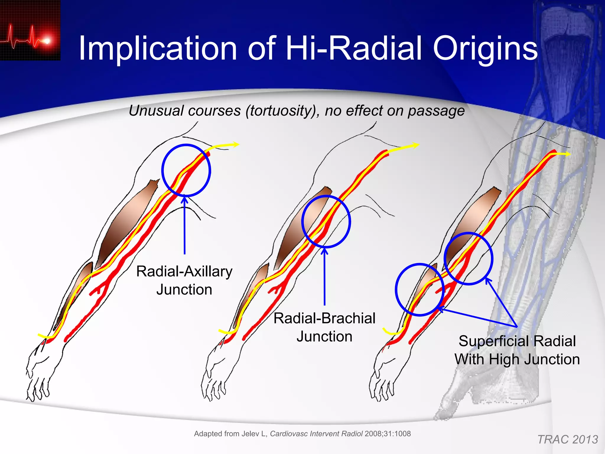 Gilchrist IC - Anatomy of radial and brachial arteries | PDF