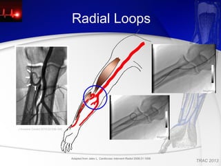 Gilchrist IC - Anatomy of radial and brachial arteries | PDF | Death, Injury, or Military ...