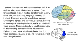 Visual Agnosia Brain