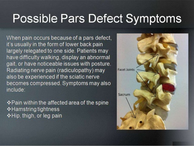 Pars Defect Causes Symptoms Treatment Exercise Diagno