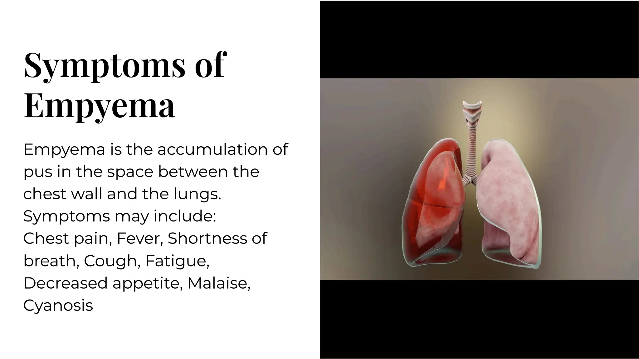 Understanding the Difference between Empyema and Emphysema.pdf