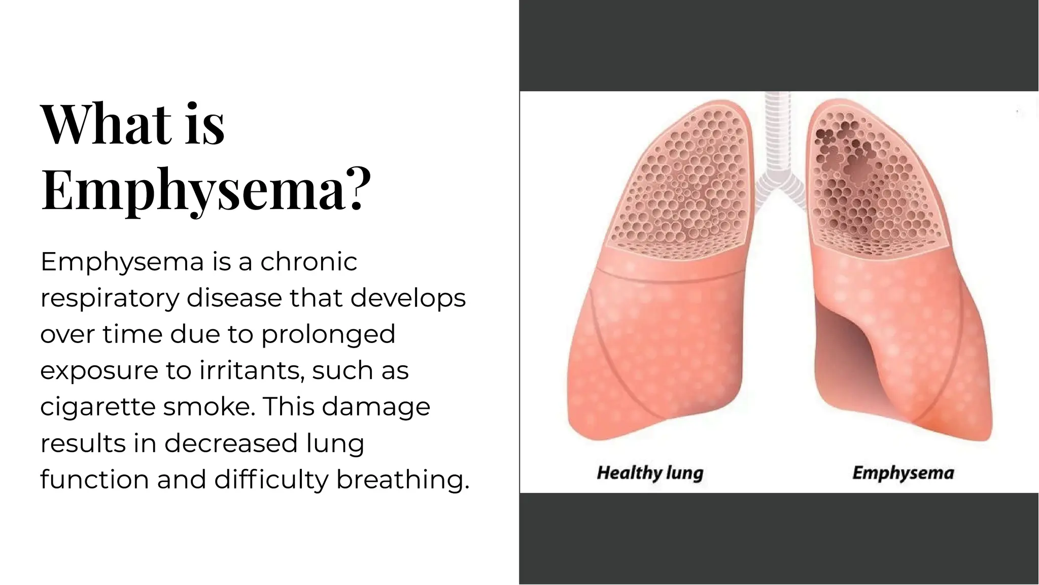 Understanding the Difference between Empyema and Emphysema.pdf