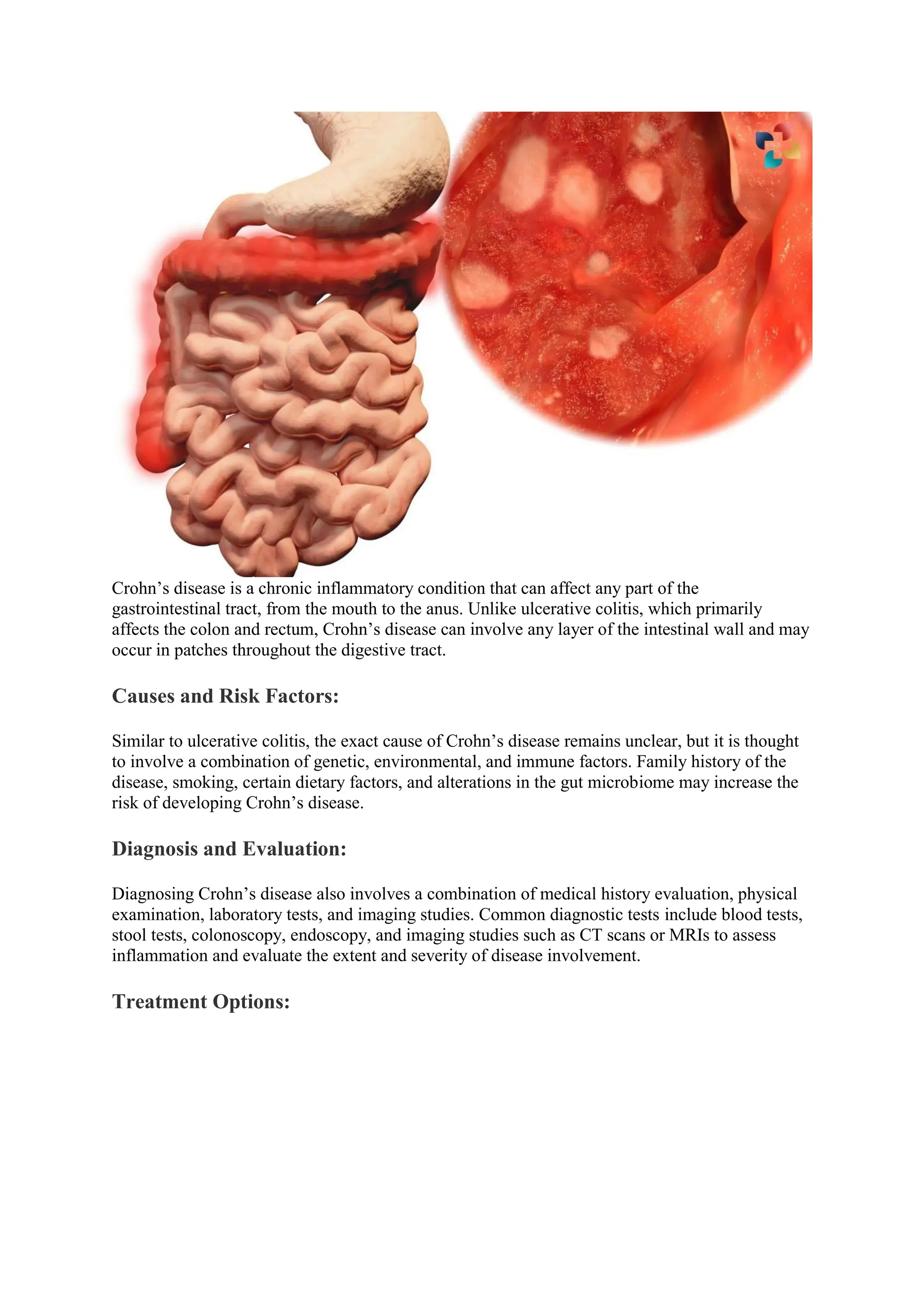 Differences Between Ulcerative Colitis vs Crohn's Disease | The ...