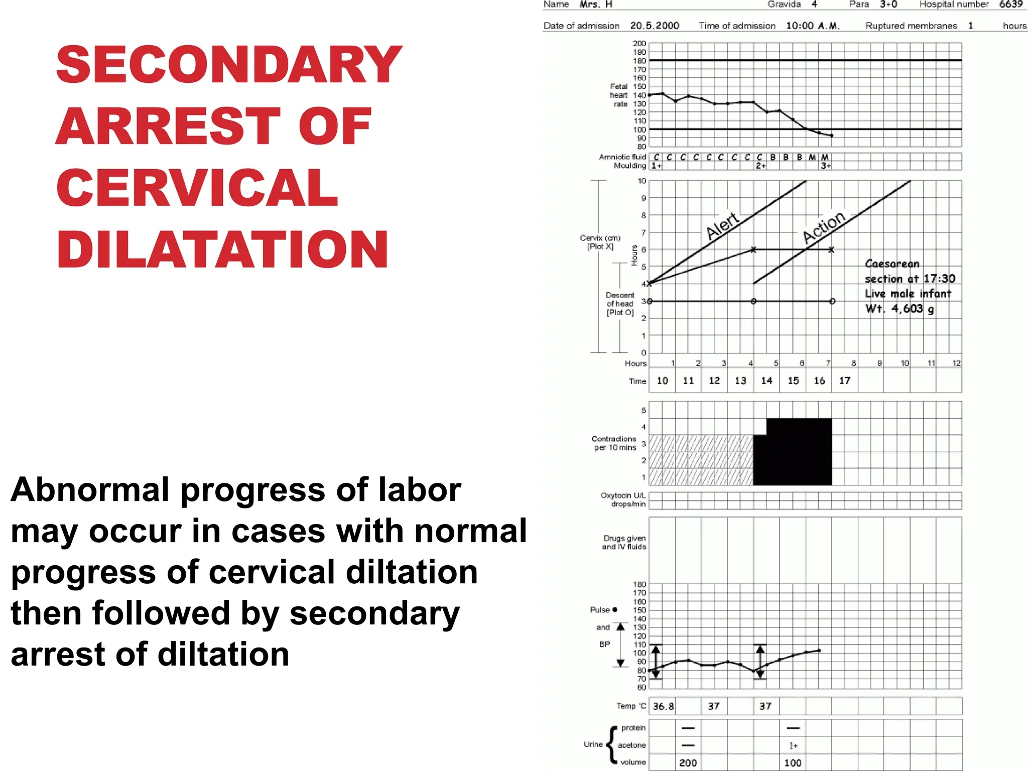 UNDERSTANDING THE PARTOGRAPH FOR LABOR MANAGEMENT | PPT