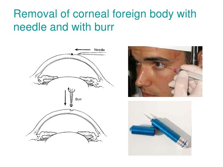 Understanding the slit lamp