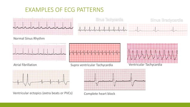 Understanding your heart health with your helo | PPT