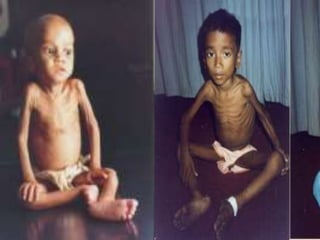 Underweight Children