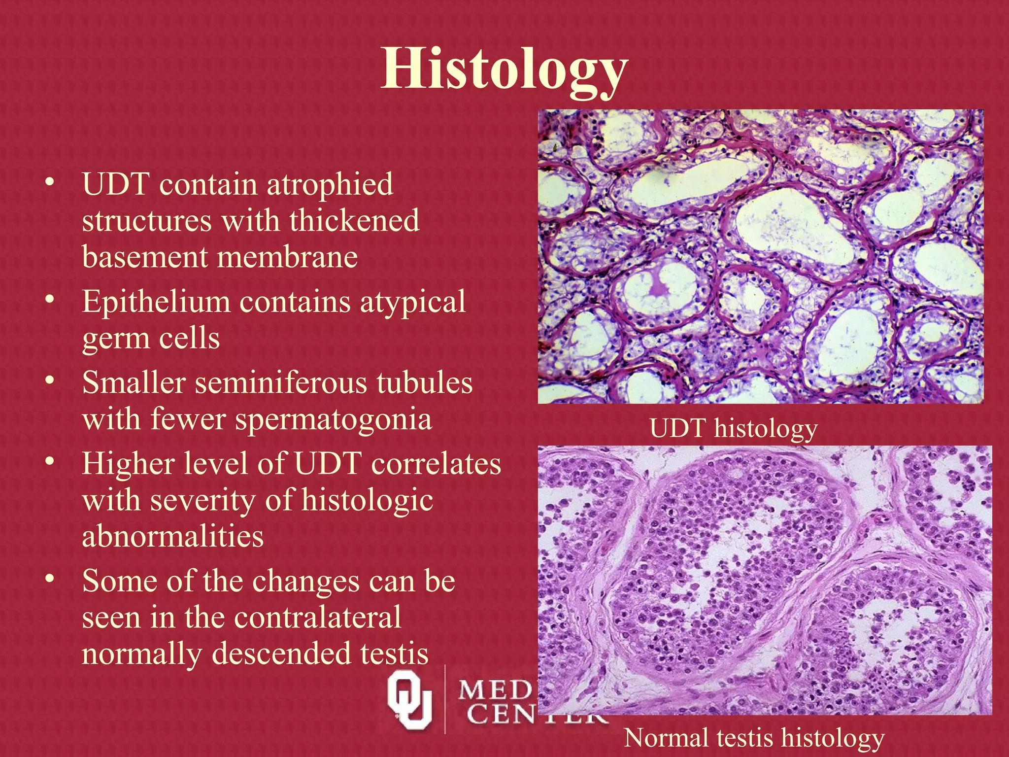 Undescended testicle | PPT