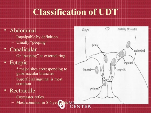 Undescended testicle