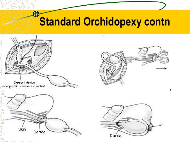 evaluation of Undescended testes