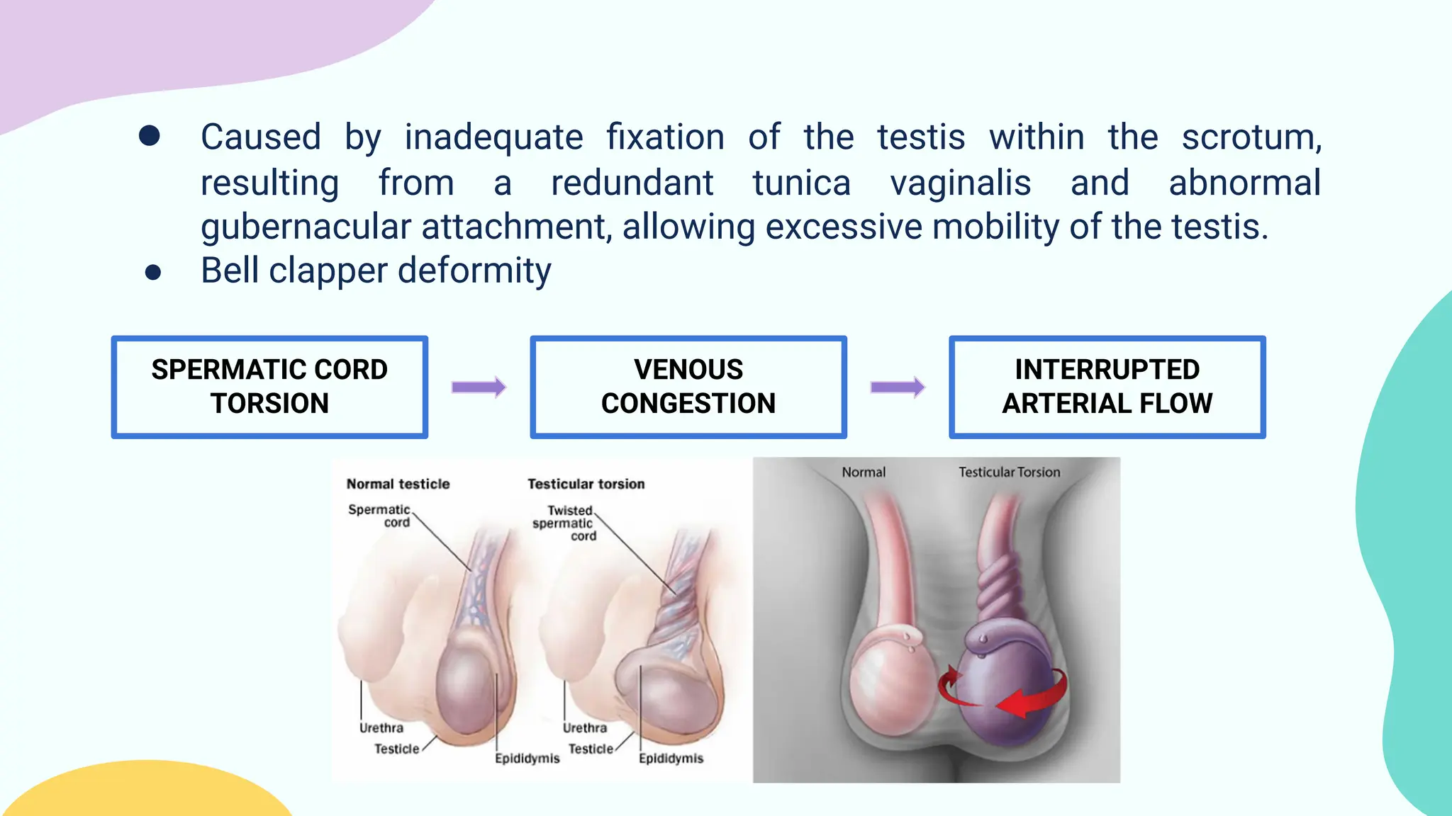 Undescended Testes Hydrocele Testicular Torsion Pdf