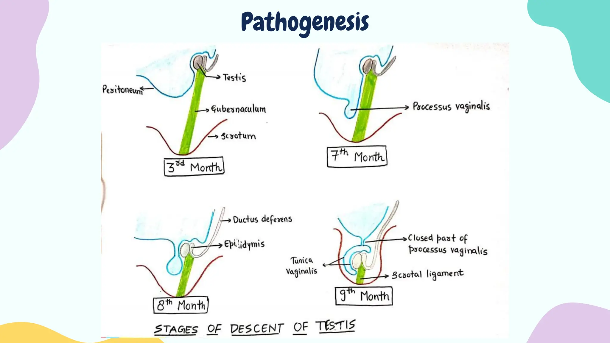 Undescended Testes, Hydrocele, Testicular Torsion.pdf