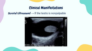 Undescended Testes, Hydrocele, Testicular Torsion.pdf