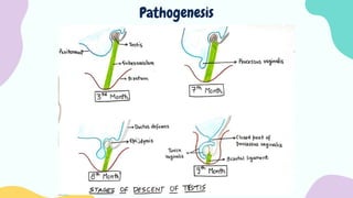 Undescended Testes, Hydrocele, Testicular Torsion.pdf