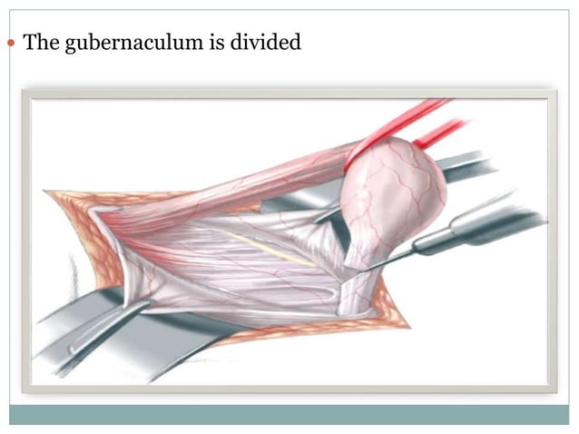 Undescended testis | PPTX