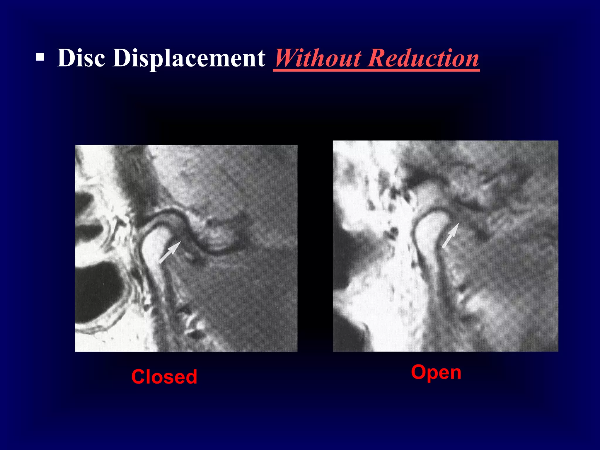 Undestanding tmj internal derangements 1 | PDF