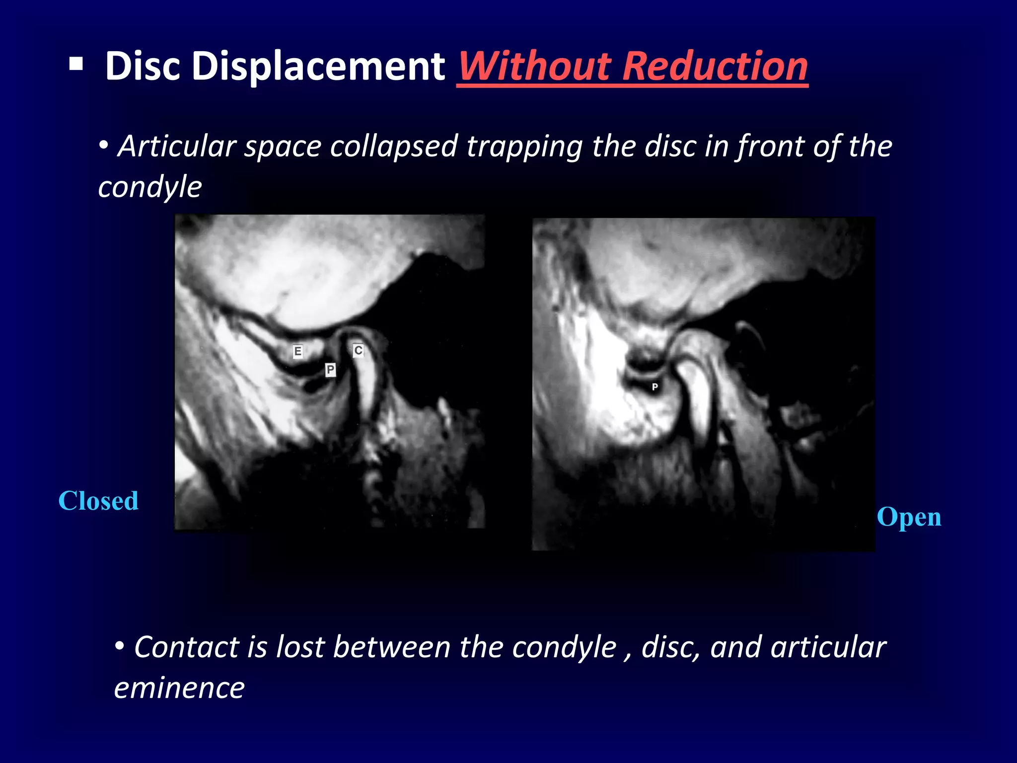 Undestanding tmj internal derangements 1 | PDF