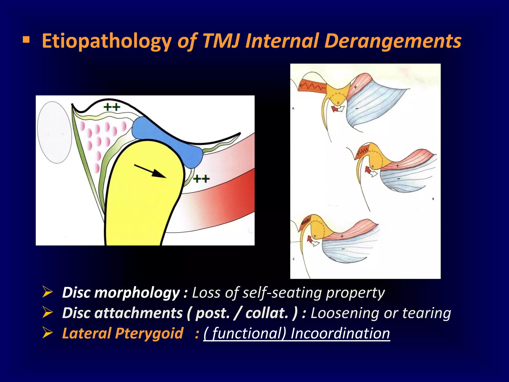 Undestanding tmj internal derangements 1 | PDF