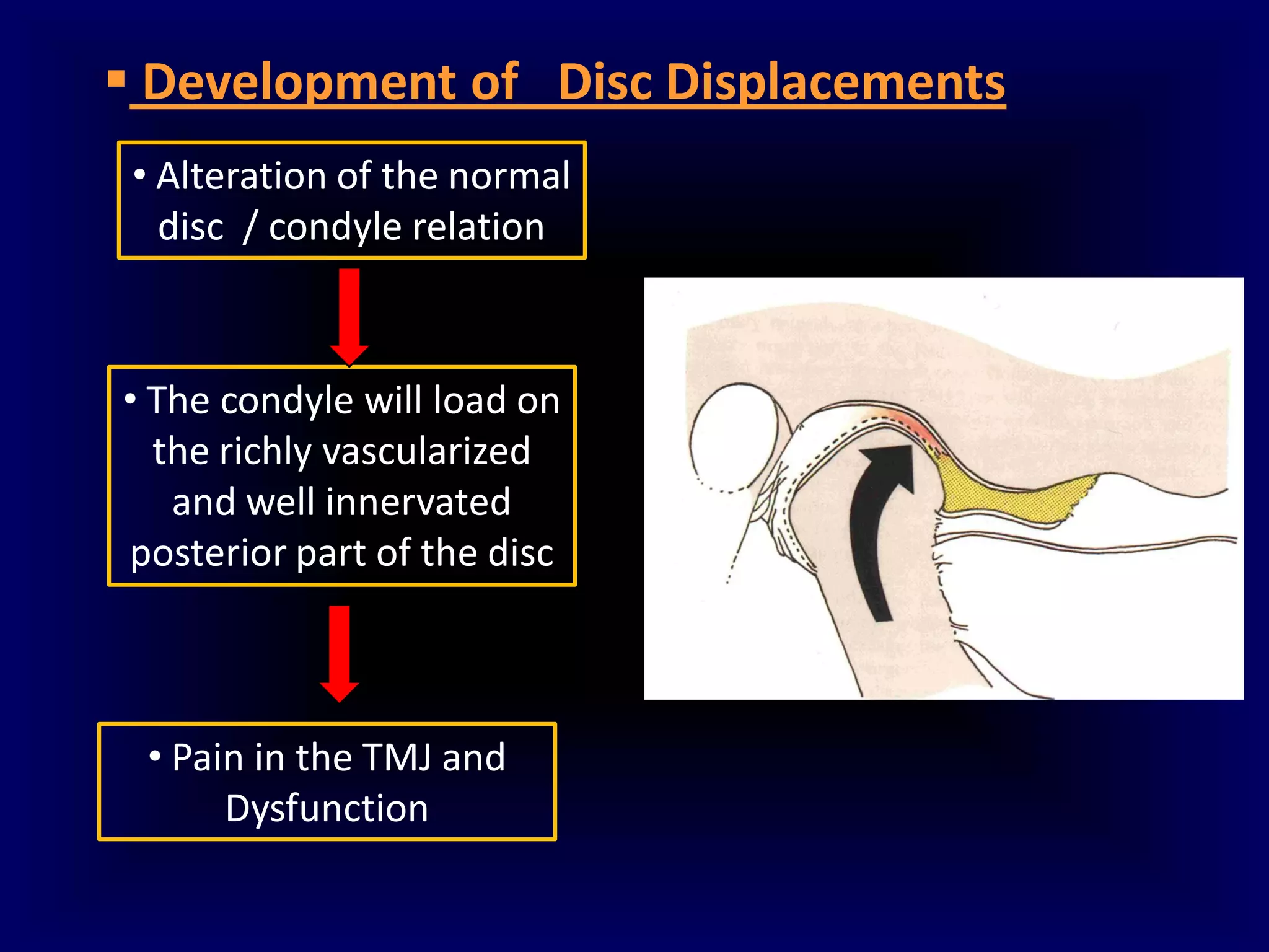 Undestanding tmj internal derangements 1 | PDF