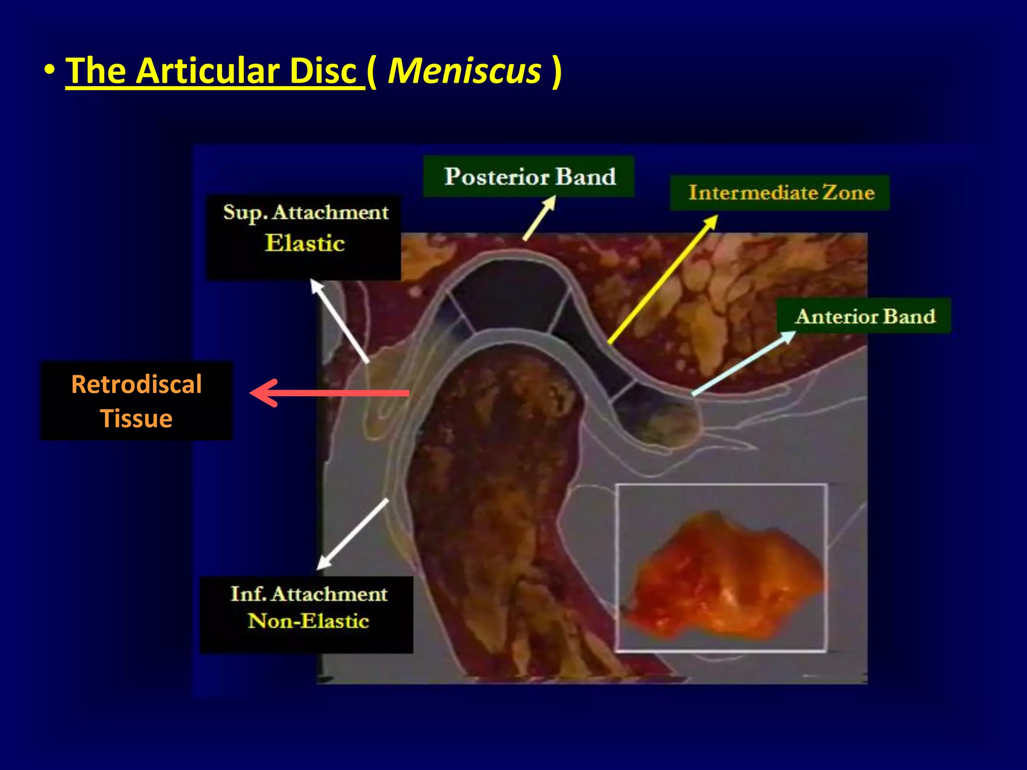 Undestanding tmj internal derangements 1 | PDF