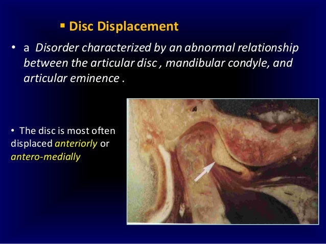 Undestanding tmj internal derangements 1