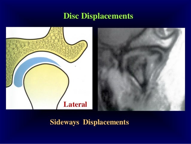 Undestanding tmj internal derangements 1