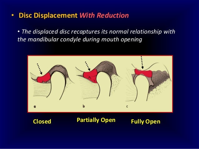 Undestanding tmj internal derangements 1