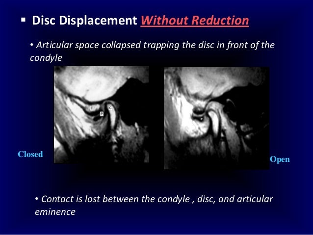Undestanding tmj internal derangements 1