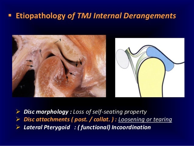 Undestanding tmj internal derangements 1
