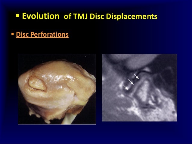 Undestanding tmj internal derangements 1