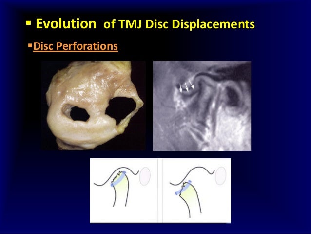 Undestanding tmj internal derangements 1