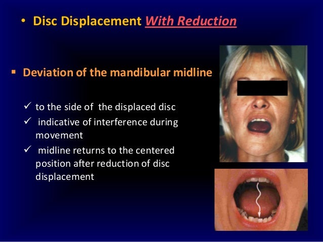 Undestanding tmj internal derangements 1