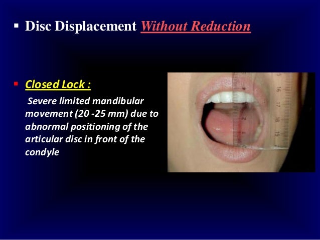 Undestanding tmj internal derangements 1