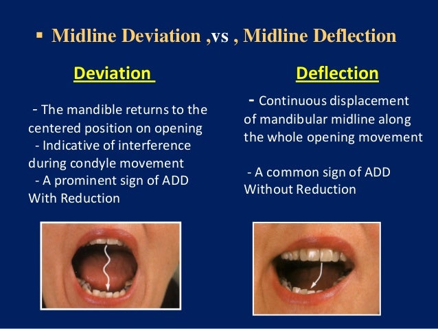 Undestanding tmj internal derangements 1