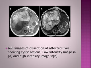 Undifferentiated embryonal sarcoma of liver | PPT